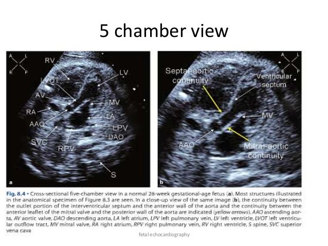 Fetal Echocardiography
