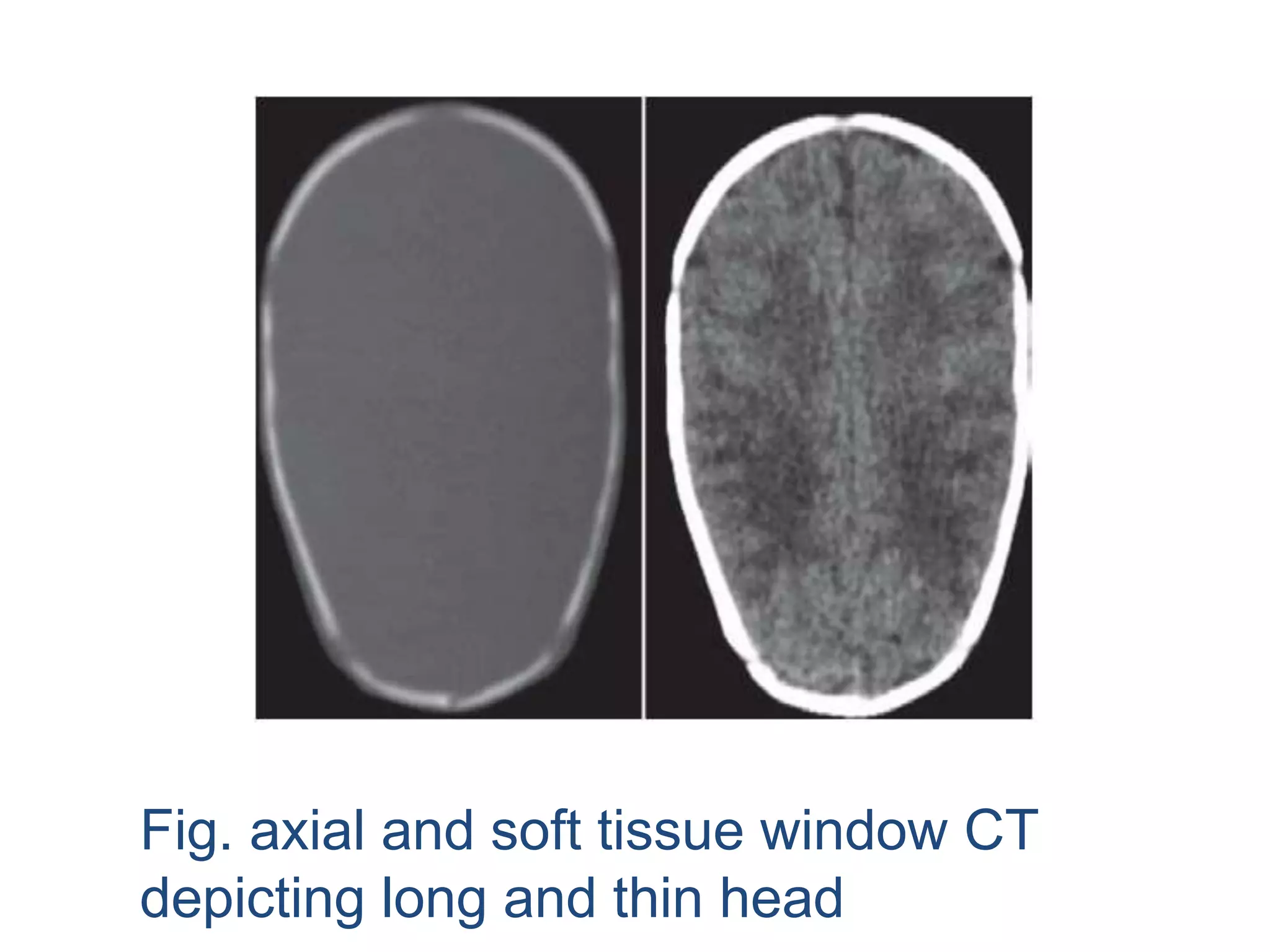 Congenital skeletal anomalies | PPTX