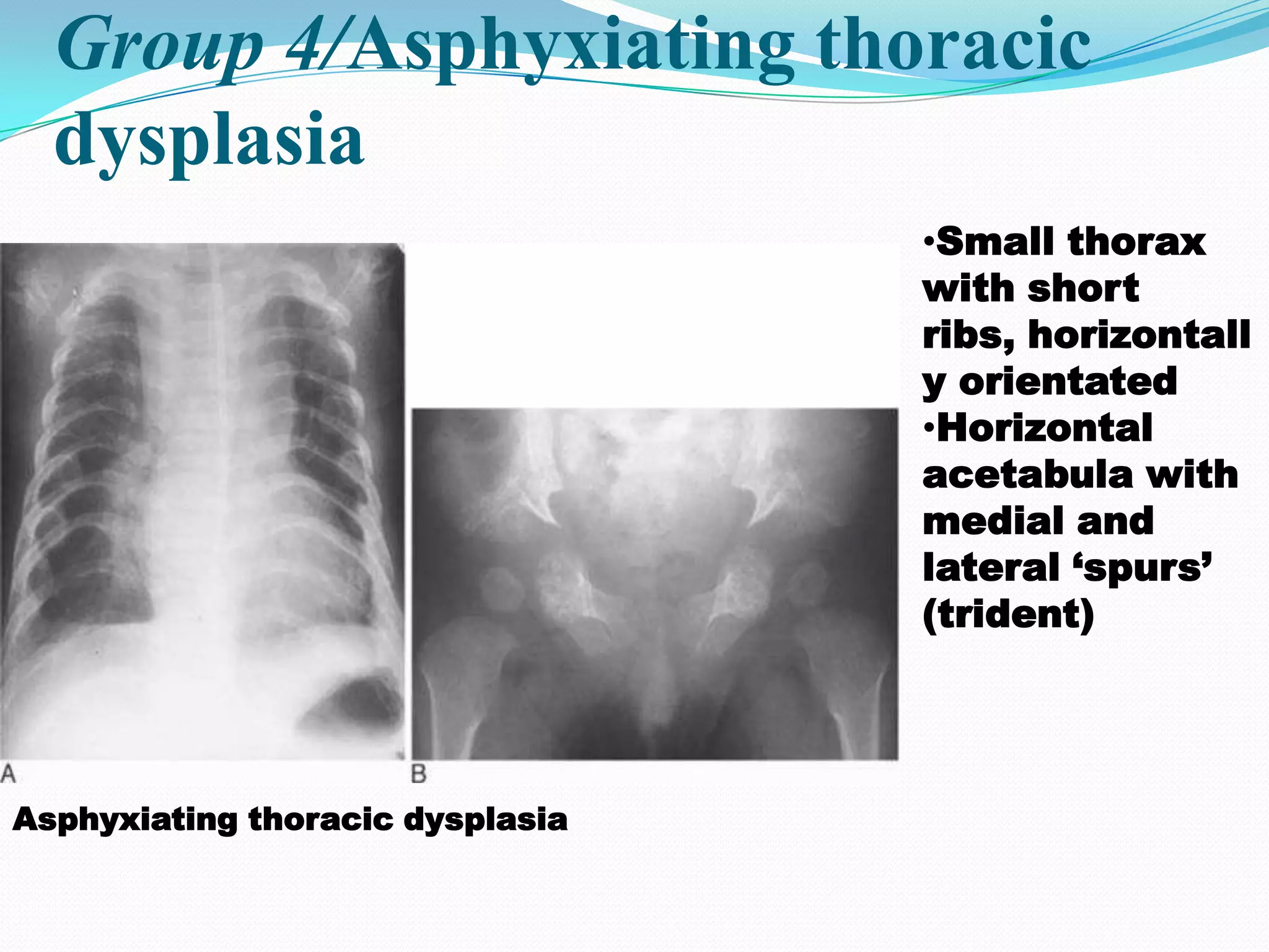 Radiological approach to Congenital skeletal dysplasia | PPTX