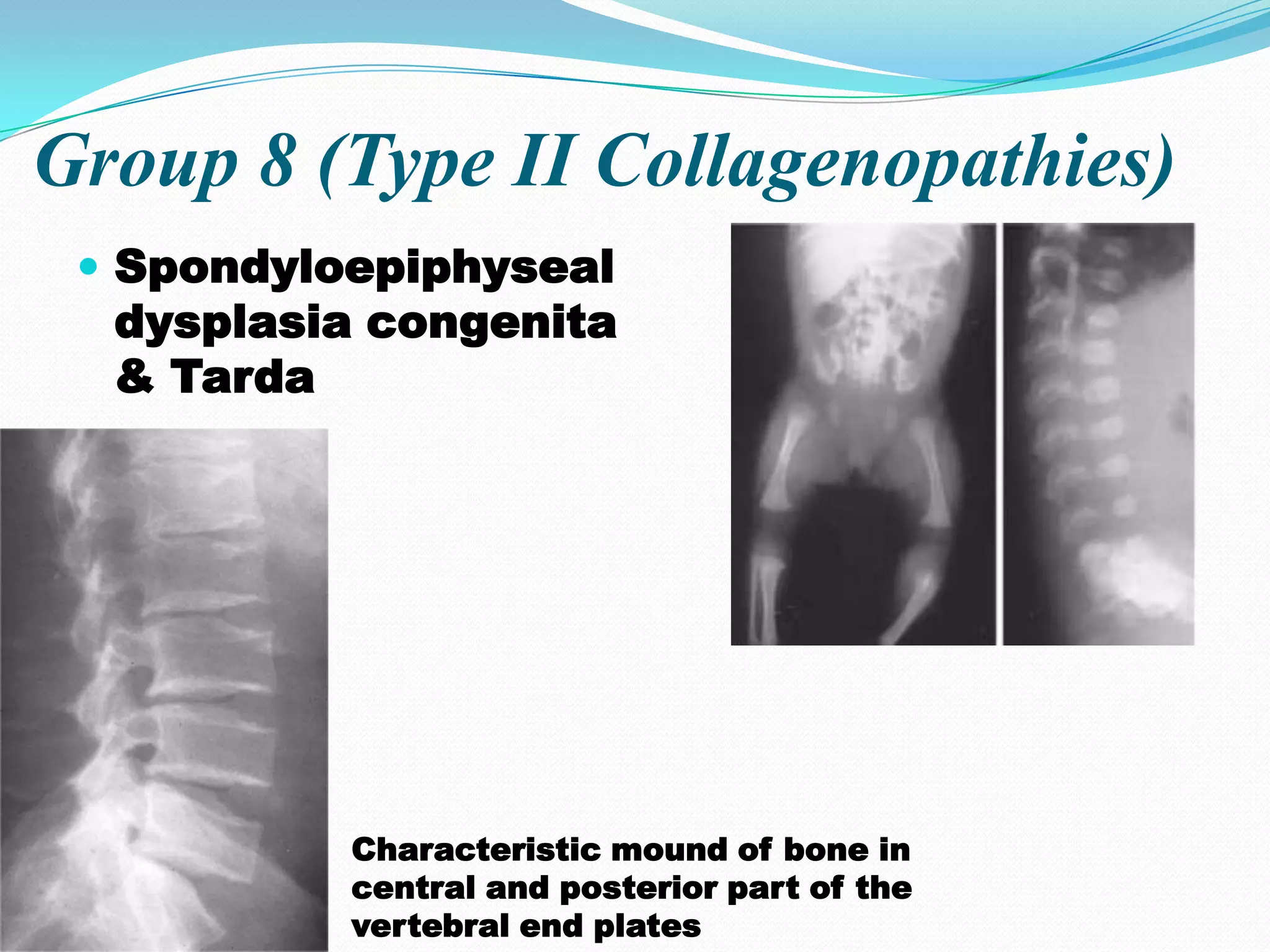 Radiological approach to Congenital skeletal dysplasia | PPTX