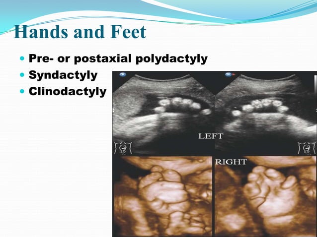Radiological approach to Congenital skeletal dysplasia | PPTX