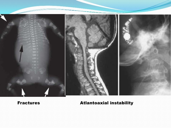 Skeletal Dysplasia