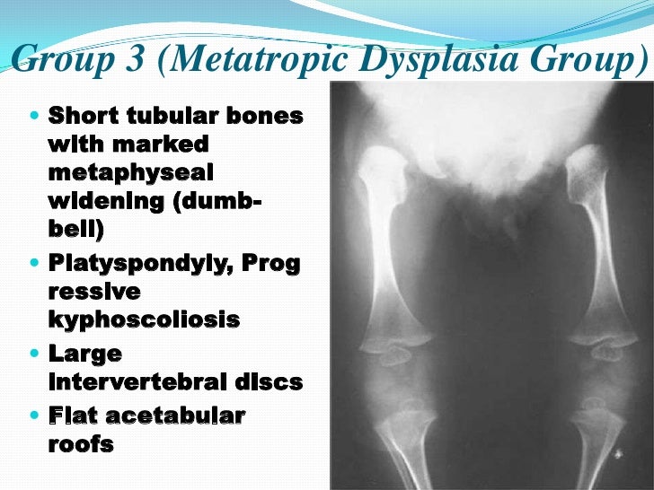 Radiological approach to Congenital skeletal dysplasia