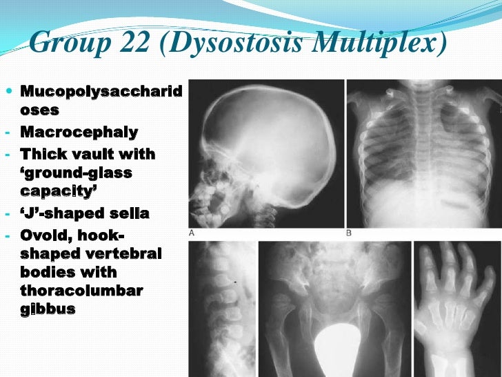 Radiological approach to Congenital skeletal dysplasia