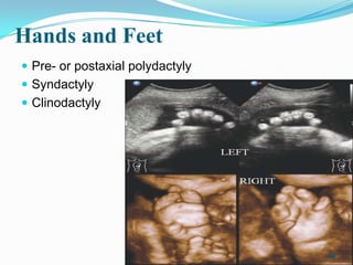 imaging in intrauterine skeletal dysplasia | PPTX