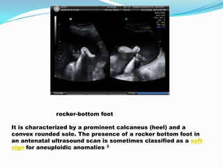Rocker Bottom Feet Ultrasound