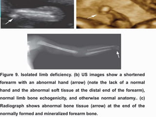 imaging in intrauterine skeletal dysplasia | PPTX