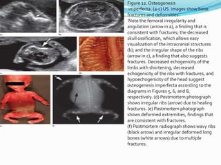 imaging in intrauterine skeletal dysplasia | PPTX