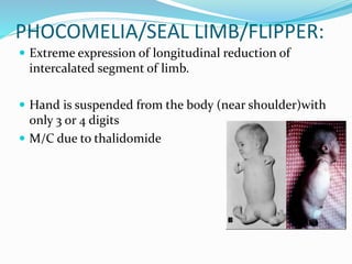Congenital skeletal limb deficiences | PPTX