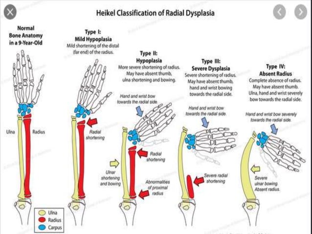 Congenital skeletal limb deficiences | PPTX