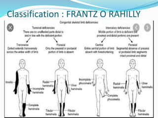 Congenital Limb Deficiency