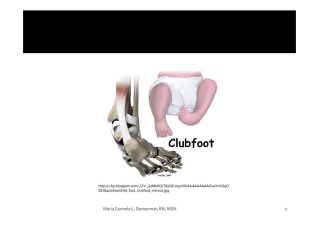 Congenital skeletal malformations | PDF | Foot Health | Diseases and ...
