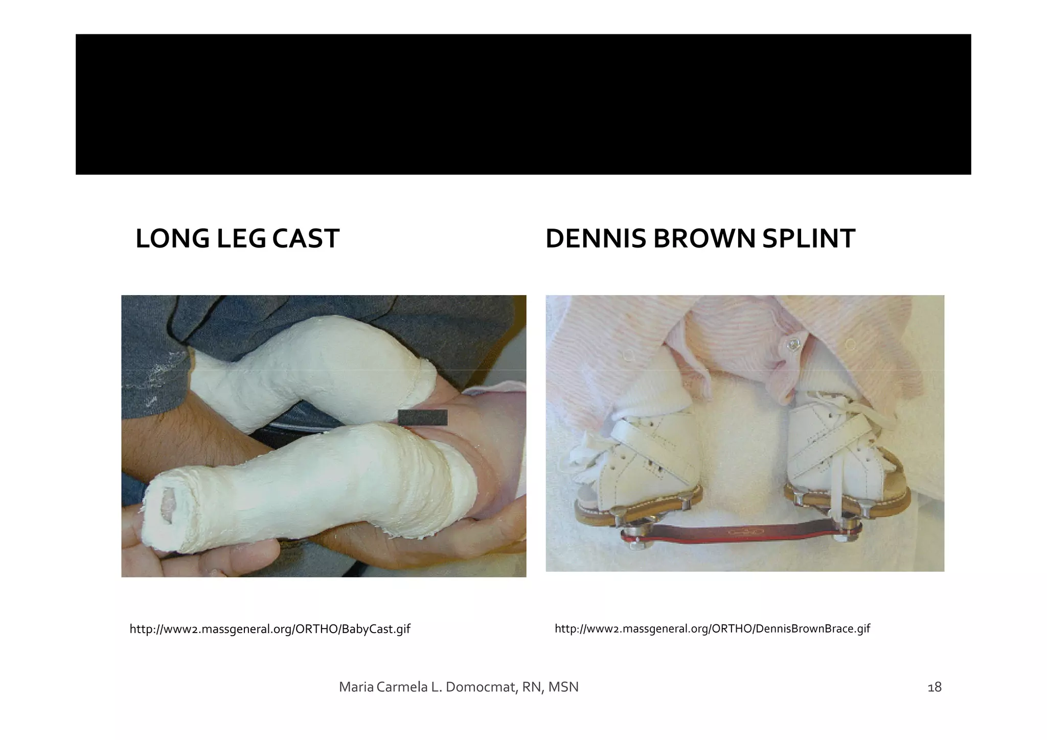 Musculoskeletal disorders Part 8 Congenital skeletal malformations | PDF