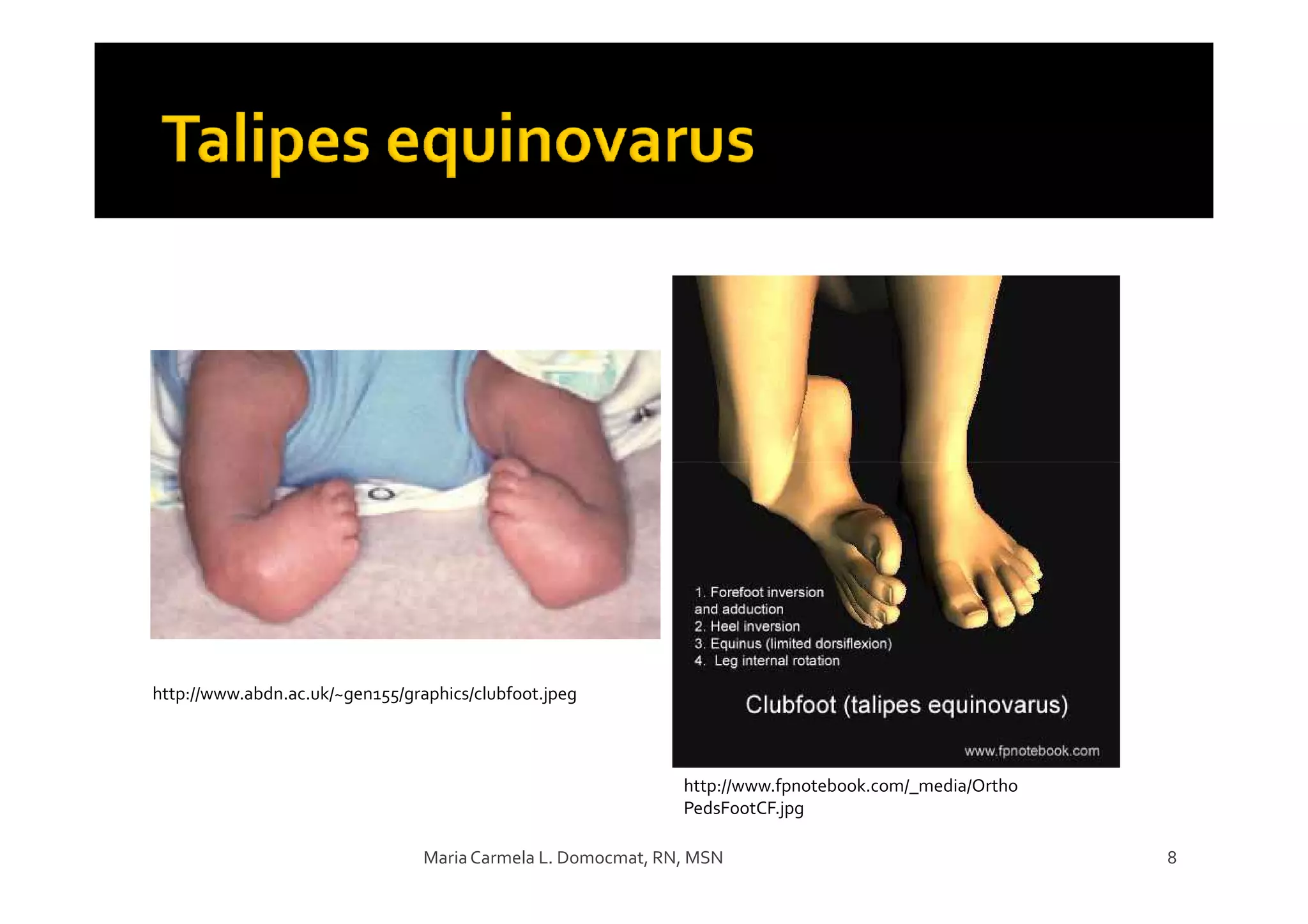 Musculoskeletal disorders Part 8 Congenital skeletal malformations | PDF