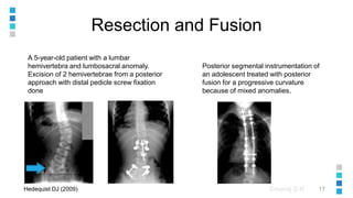 Physiotherapy for Congenital Spine Deformities | PPTX