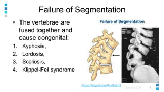 Physiotherapy for Congenital Spine Deformities | PPTX