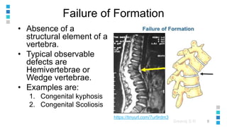 Physiotherapy for Congenital Spine Deformities | PPTX