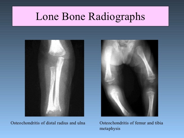 Clutton Joints Risk Factors And Management Of Prosthetic Joint
