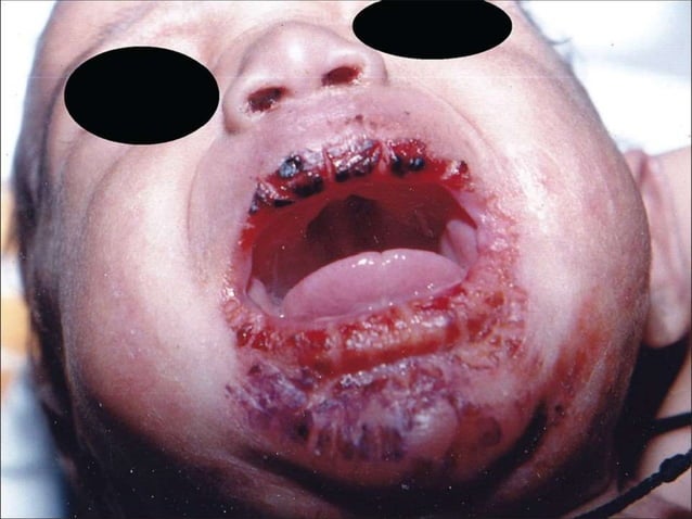 Congenital syphilis | PPT