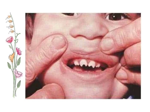 Congenital syphilis | PPT