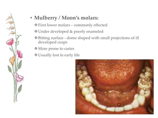 Congenital syphilis | PPT