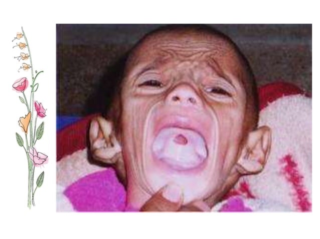 Congenital syphilis | PPT