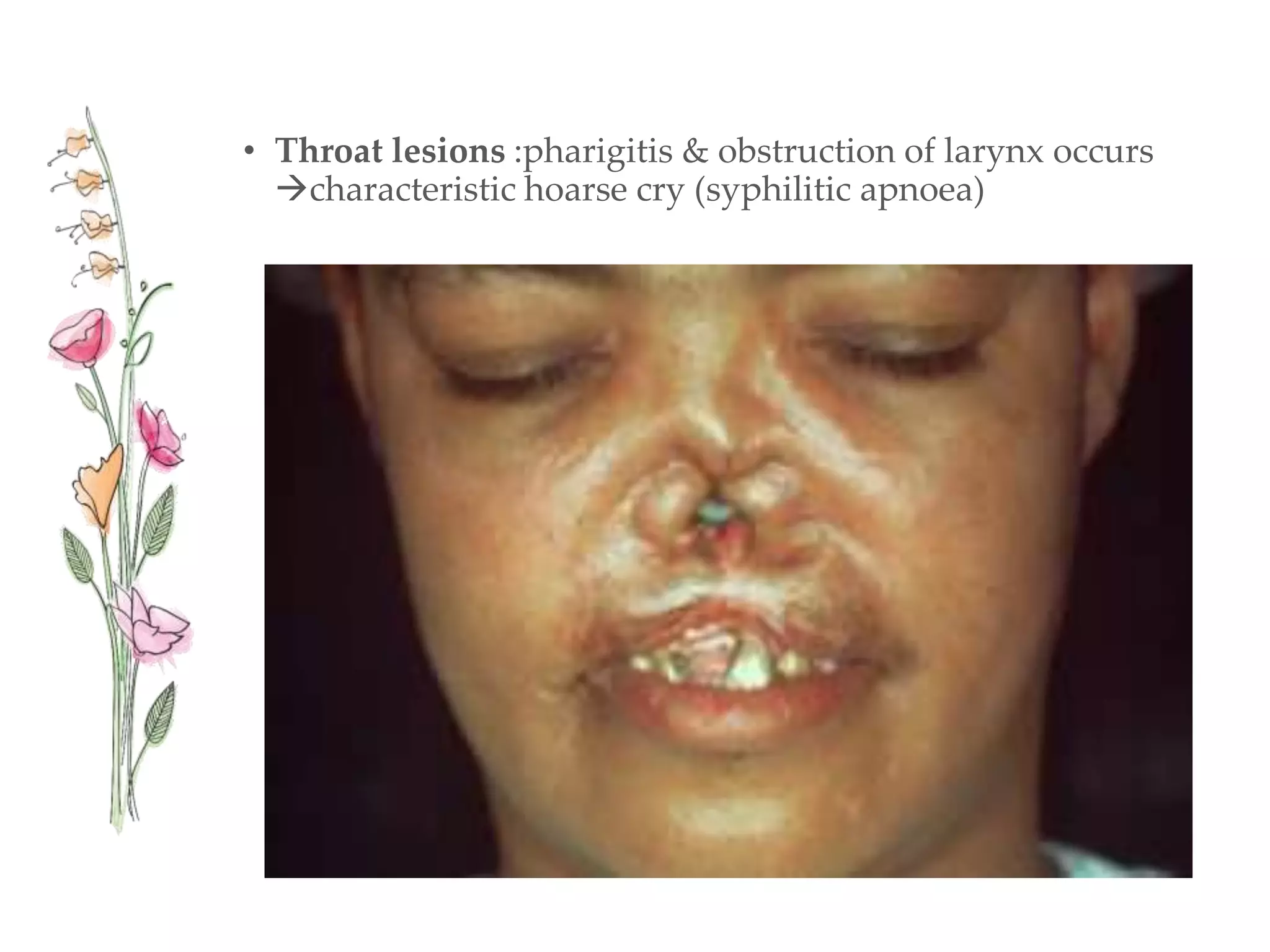 congenitalsyphilis-140810152305-phpapp02 (2).pdf