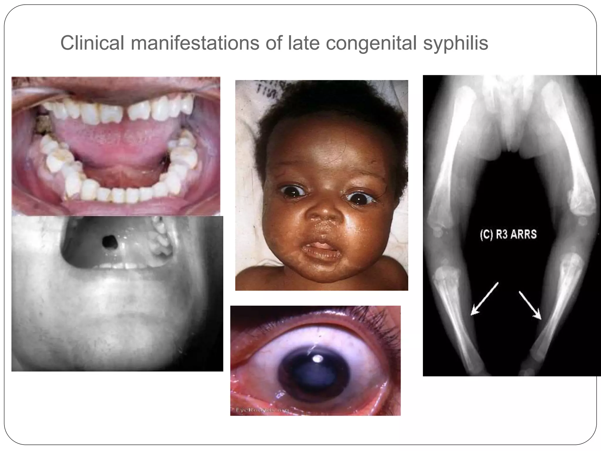 Congenital syphilis arire | PPT