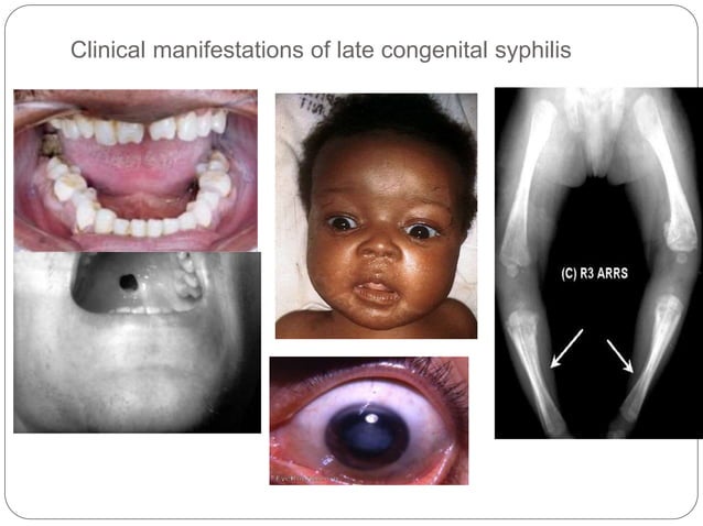 Congenital syphilis arire