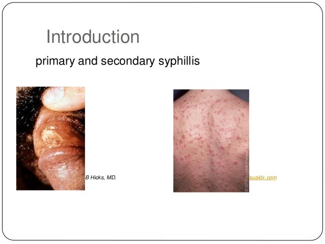 Congenital syphilis arire