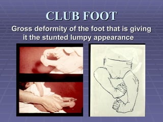 Congenital Talipes Equino-Varus.ppt Congenital Talipes Equino-Varus.ppt