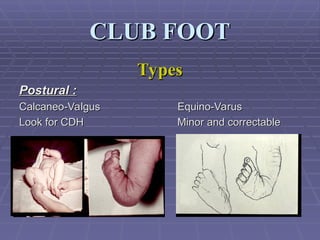 Congenital Talipes Equino-Varus.ppt Congenital Talipes Equino-Varus.ppt