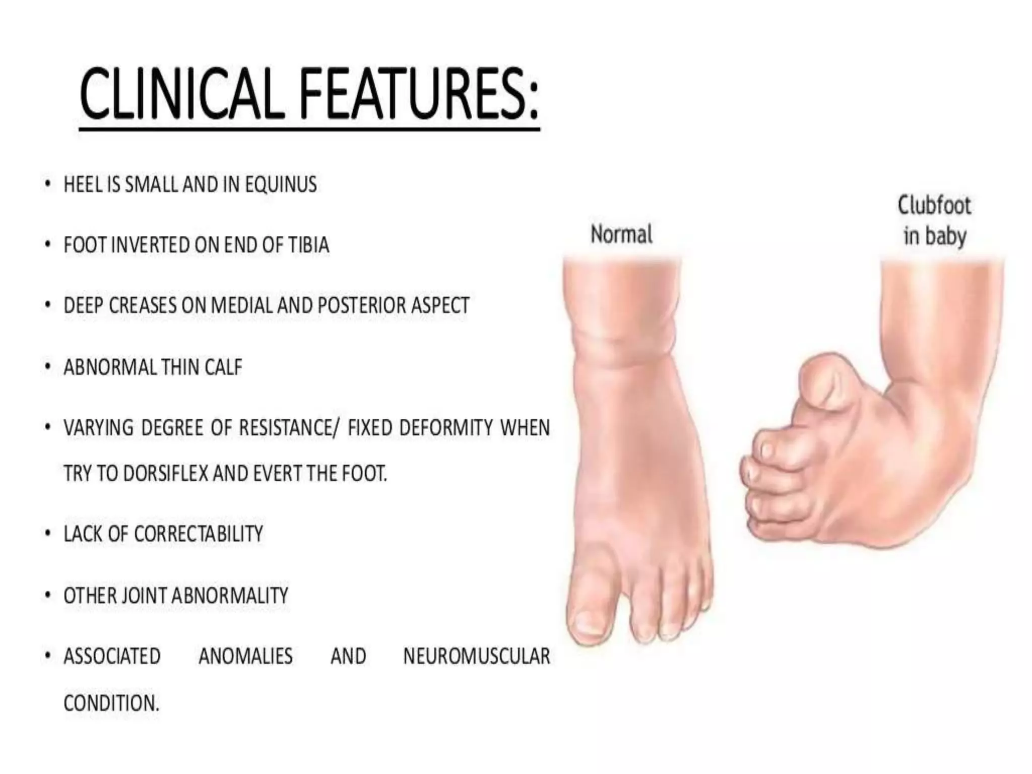 Congenital talipes equinovarus | PPTX