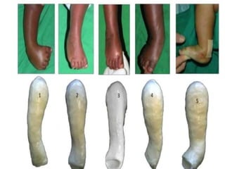 Congenital talipes equinovarus | PPTX