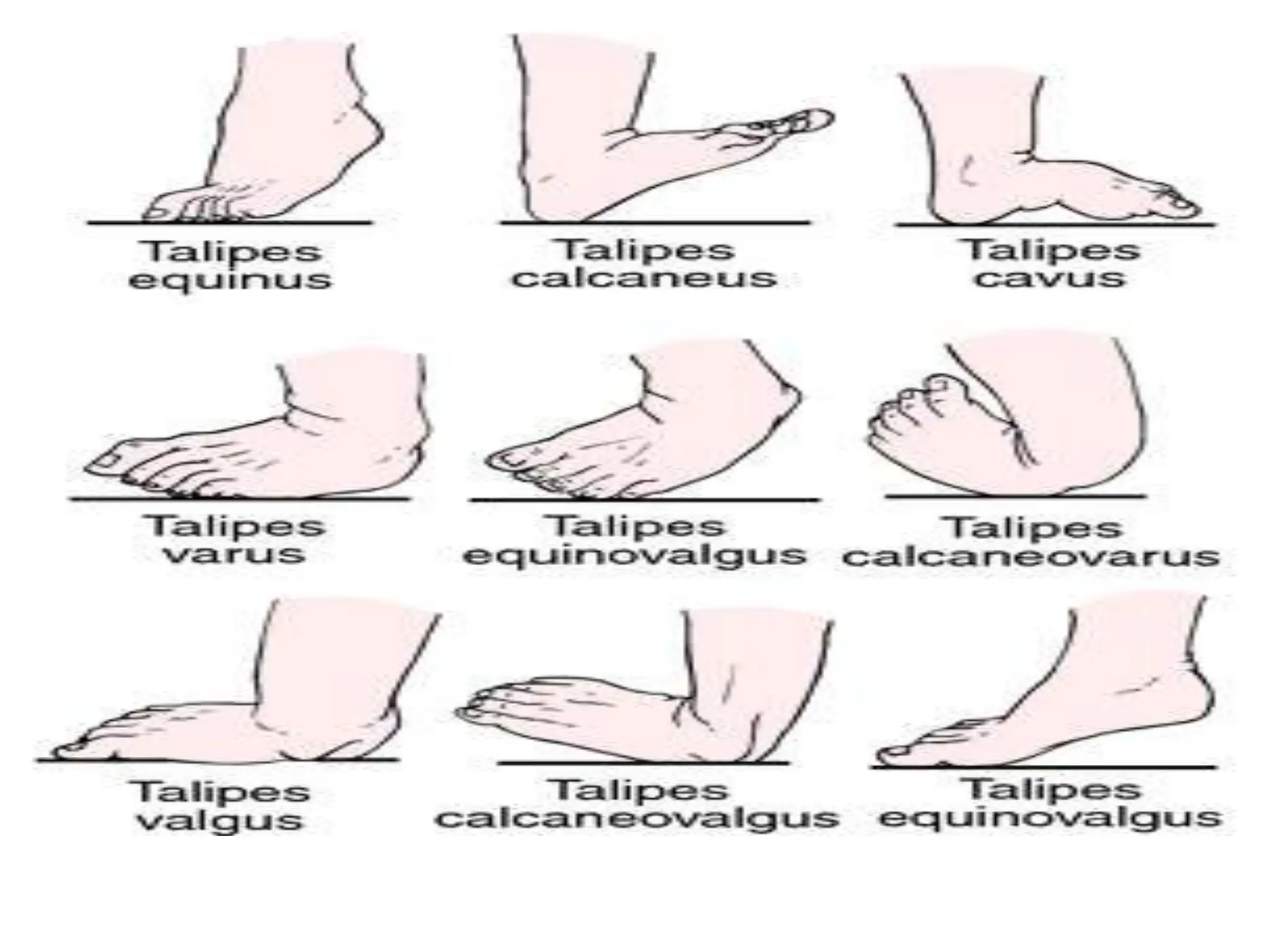 CONGENITAL TALIPES EQUINOVARUS.pptx | Foot Health | Diseases and Conditions