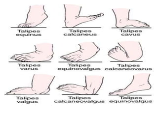CONGENITAL TALIPES EQUINOVARUS.pptx | Foot Health | Diseases and Conditions