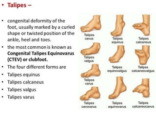 CONGENITAL TALIPES EQUINOVARUS.pptx | Foot Health | Diseases and Conditions