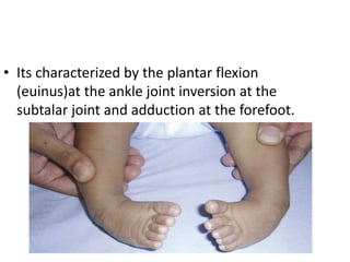 CONGENITAL TALIPES EQUINOVARUS.pptx | Foot Health | Diseases and Conditions