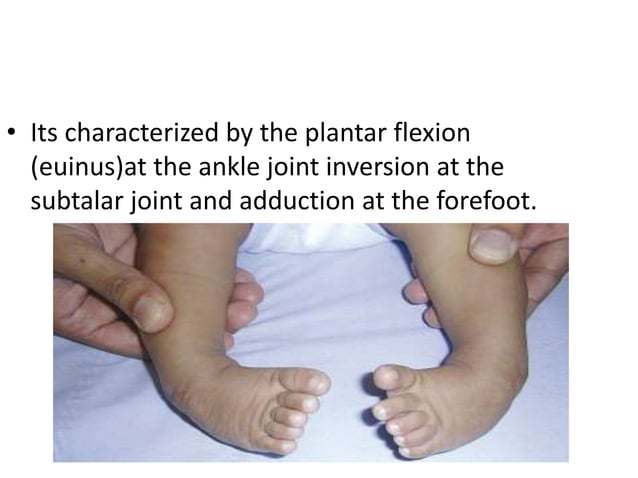 CONGENITAL TALIPES EQUINOVARUS.pptx | Foot Health | Diseases and Conditions