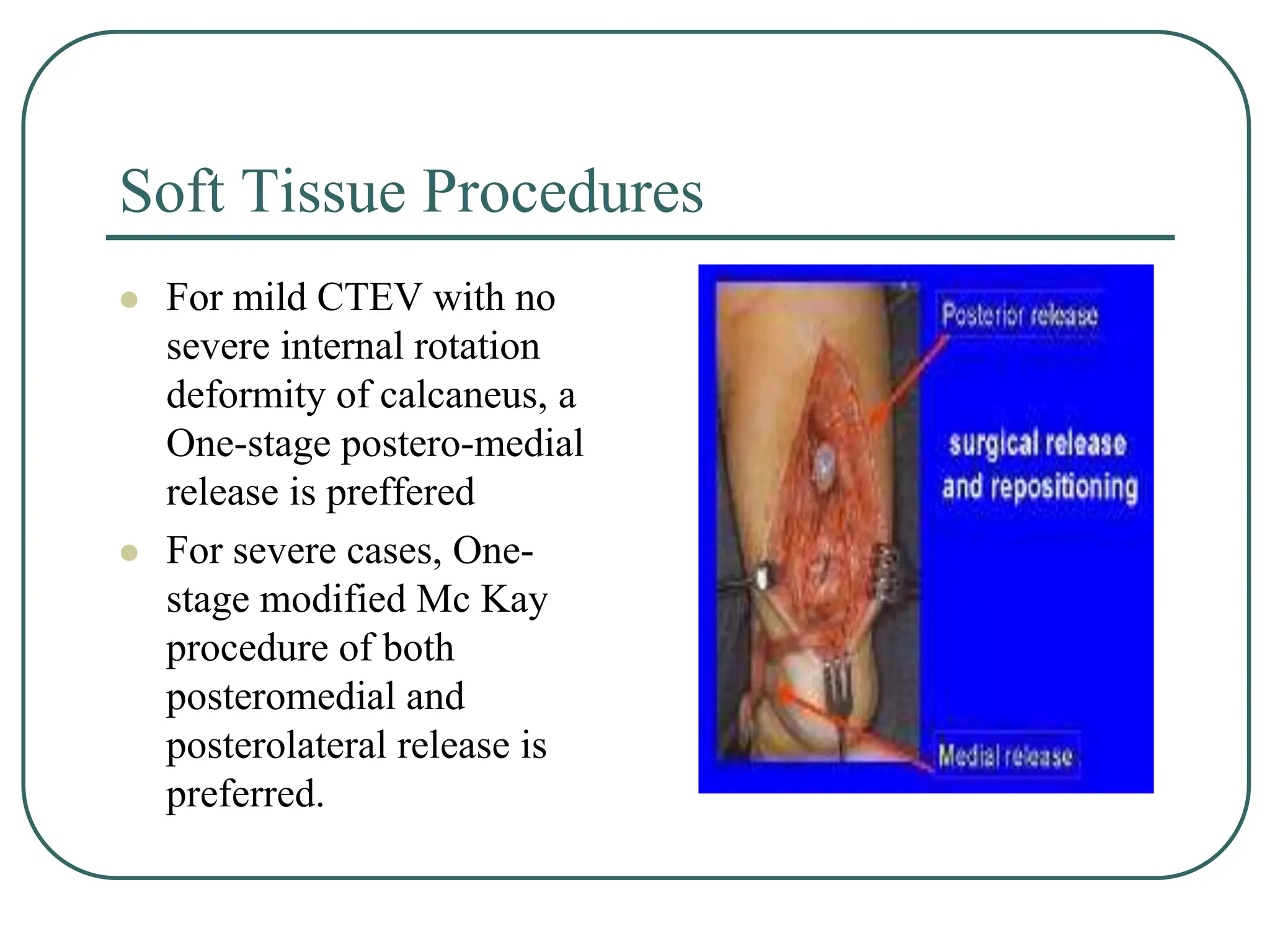 Congenital Talipes Equino Varus.pptjeiiieiu | PPT