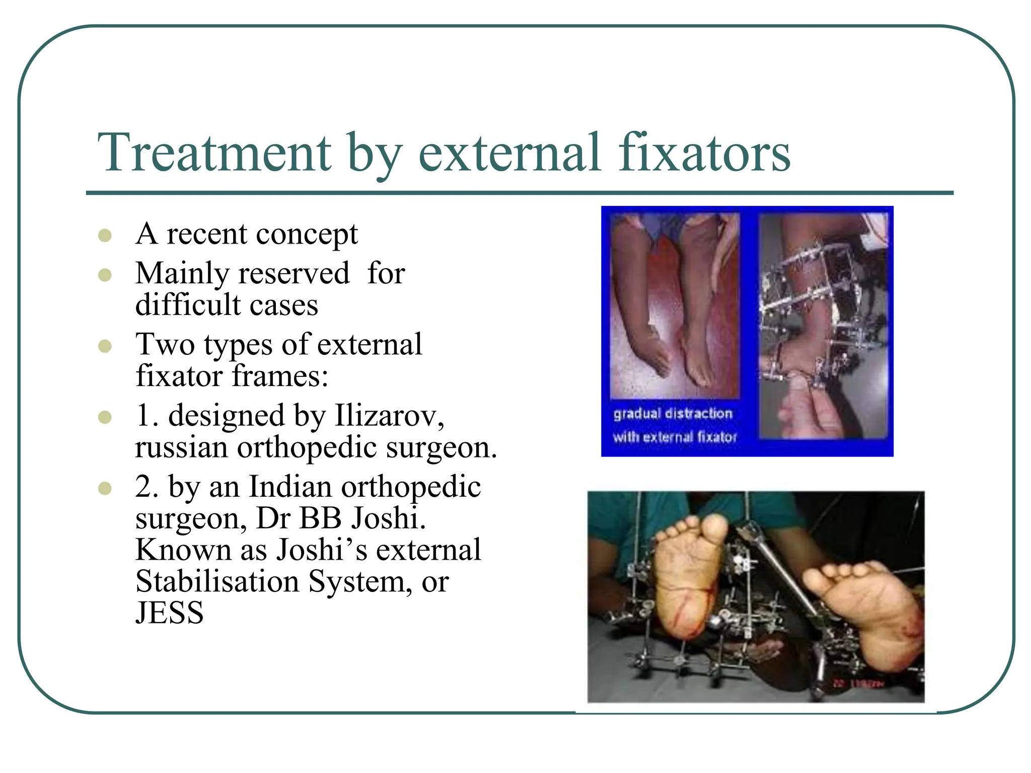 Congenital Talipes Equino Varus.pptjeiiieiu | PPT