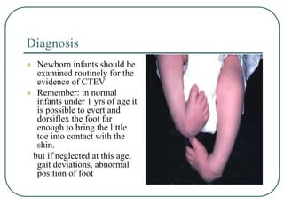 Congenital Talipes Equino Varus.pptjeiiieiu | PPT