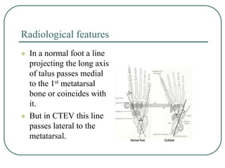 Congenital Talipes Equino Varus.pptjeiiieiu | PPT