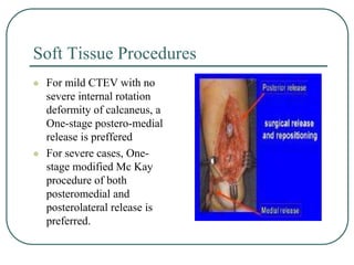 Congenital Talipes Equino Varus.pptjeiiieiu | PPT