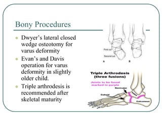 Congenital Talipes Equino Varus.pptjeiiieiu | PPT