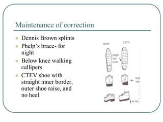 Congenital Talipes Equino Varus.pptjeiiieiu | PPT