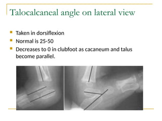 Congenital Talipes Equino Varus deformity.pptx