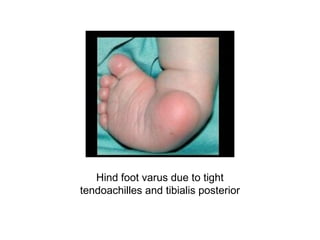 CONGENITAL TALIPES EQUINO VARUS CLUBFOOT | PPTX