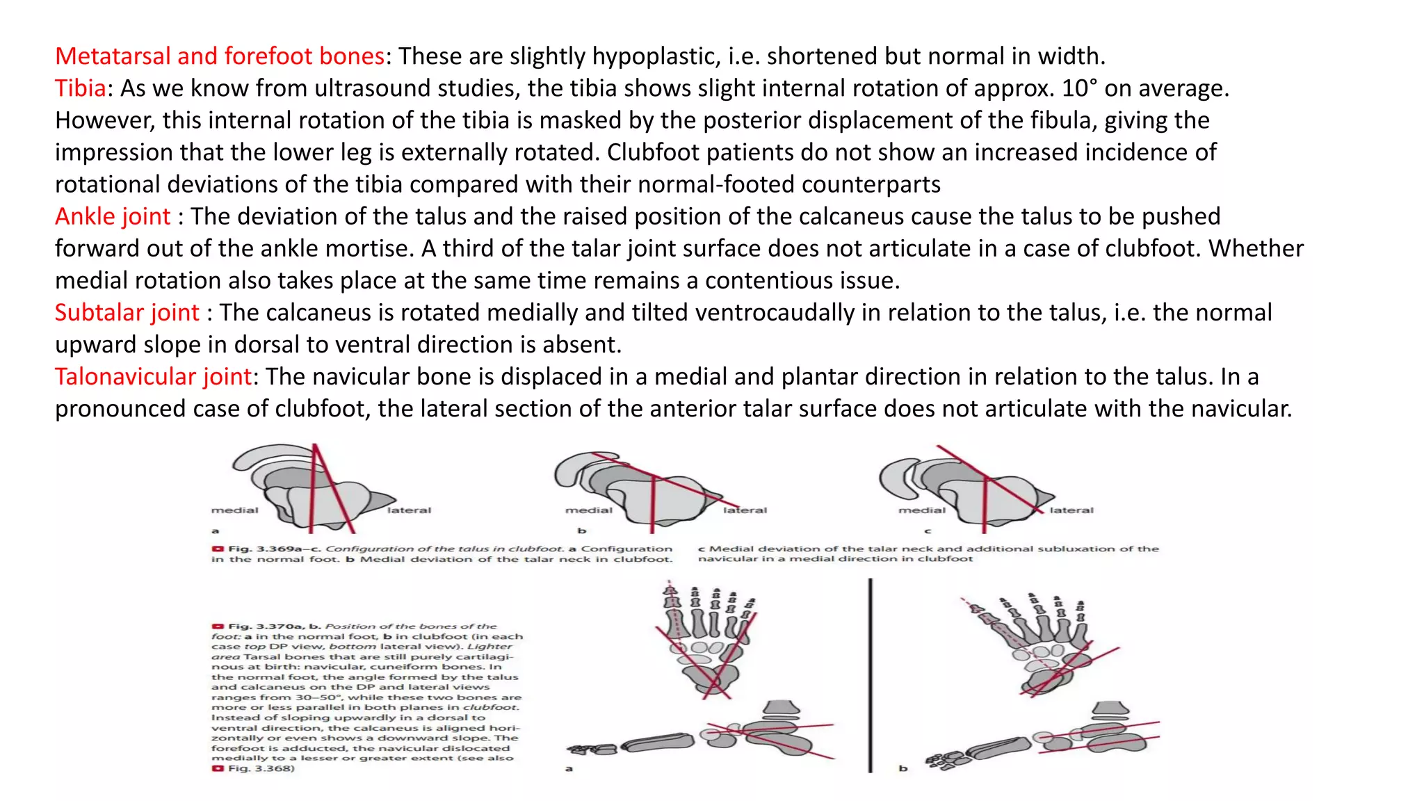CONGENITAL TALIPES EQUINOVARUS (CLUBFOOT) Physiotherapy Dr. Apurva ...