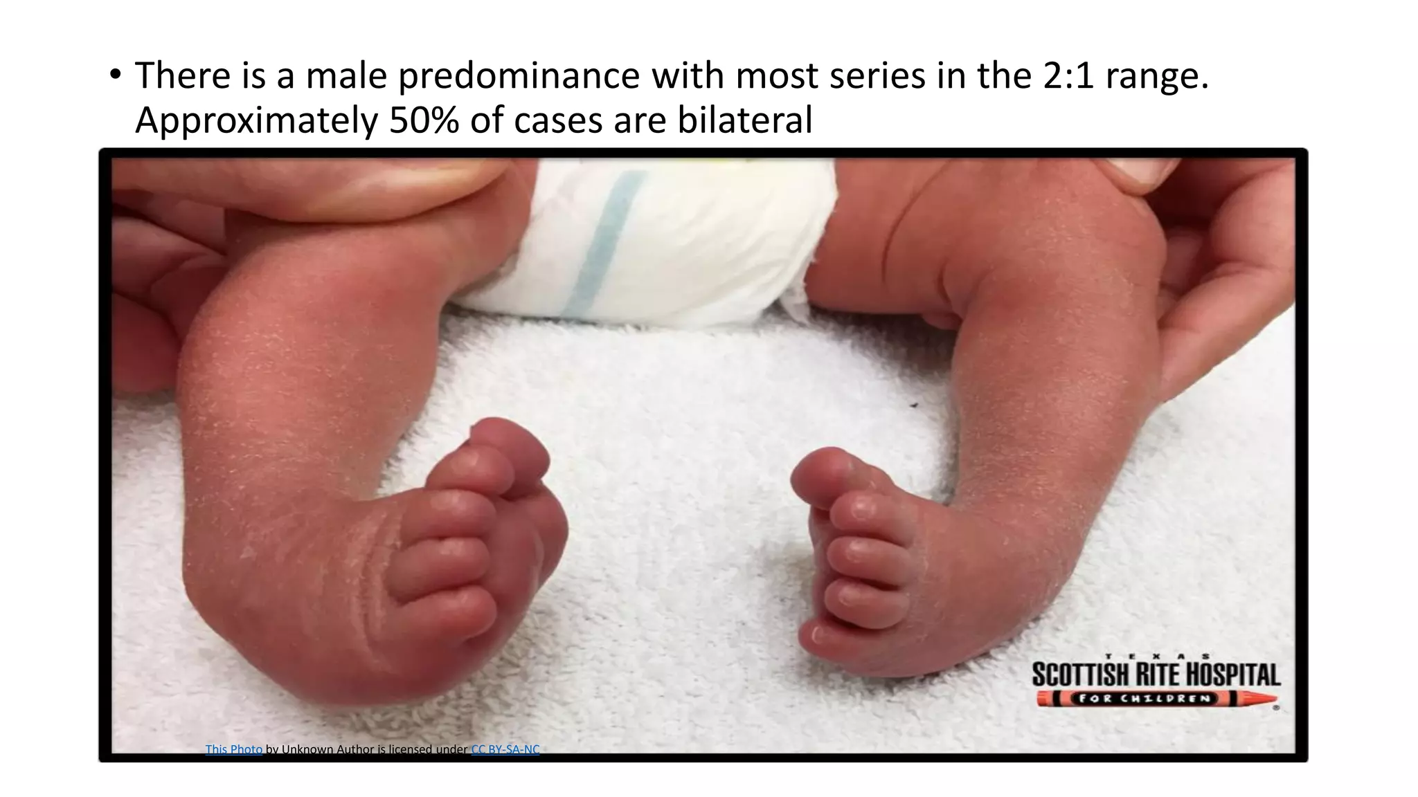 CONGENITAL TALIPES EQUINOVARUS (CLUBFOOT) Physiotherapy Dr. Apurva ...